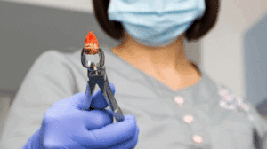 Tooth Extraction and Abscess: Myths and Truths