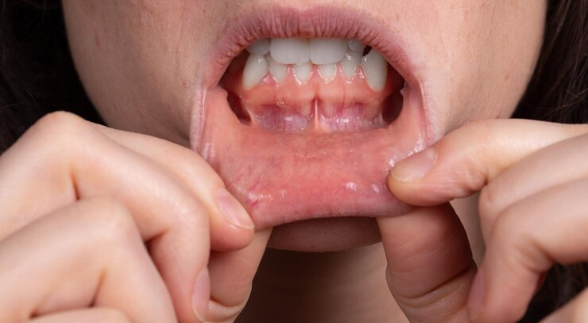 Canker Sore Symptoms And Treatment Infoupdate Canker Sore Symptoms And Treatment Infoupdate