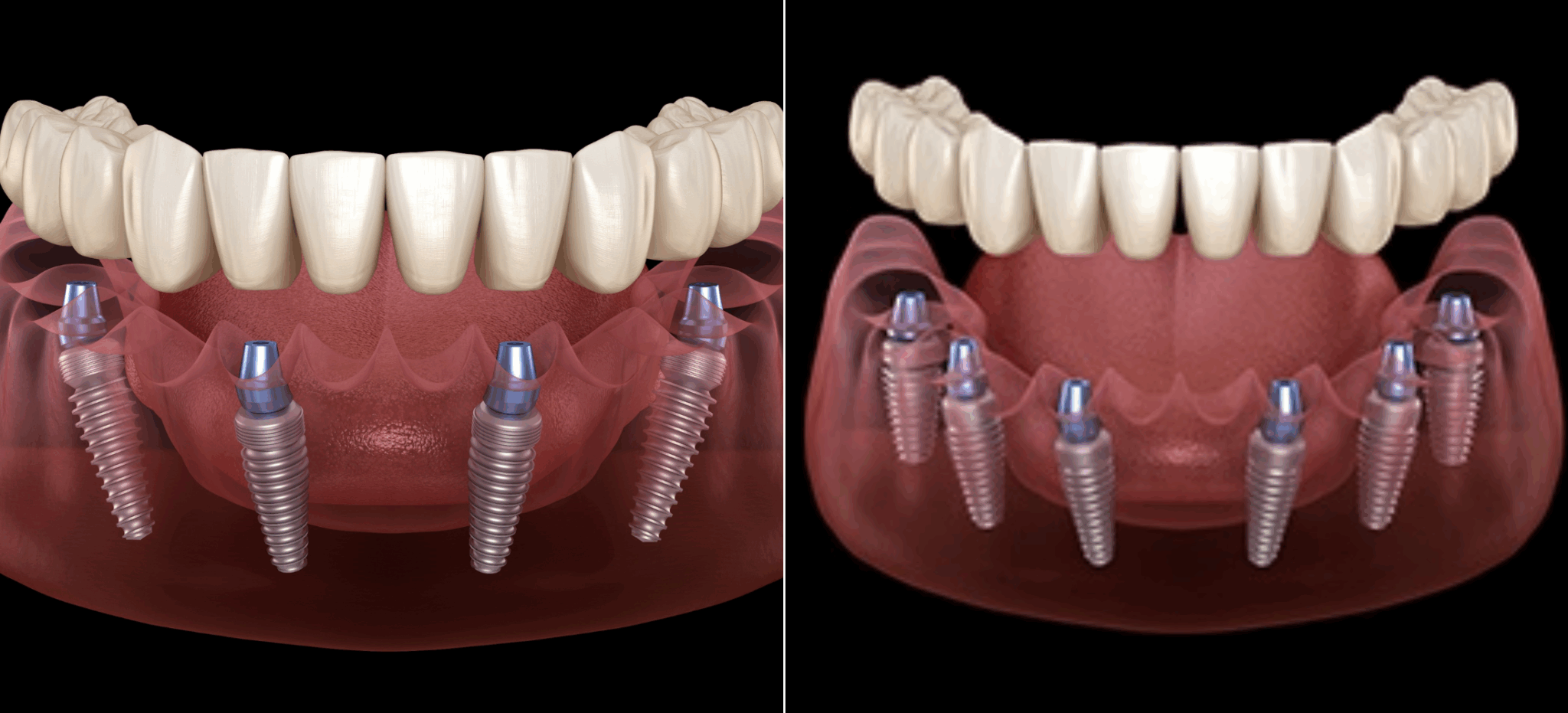 All-On-4 vs. All-On-6 Implants: Choosing the Right Solution