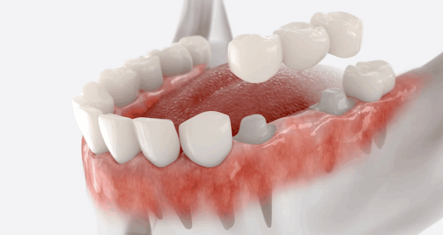 Fix Gap Between Crown and Gum: Solutions & Tips